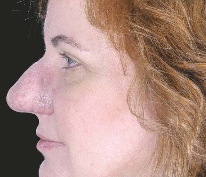 Early Rhinophyma