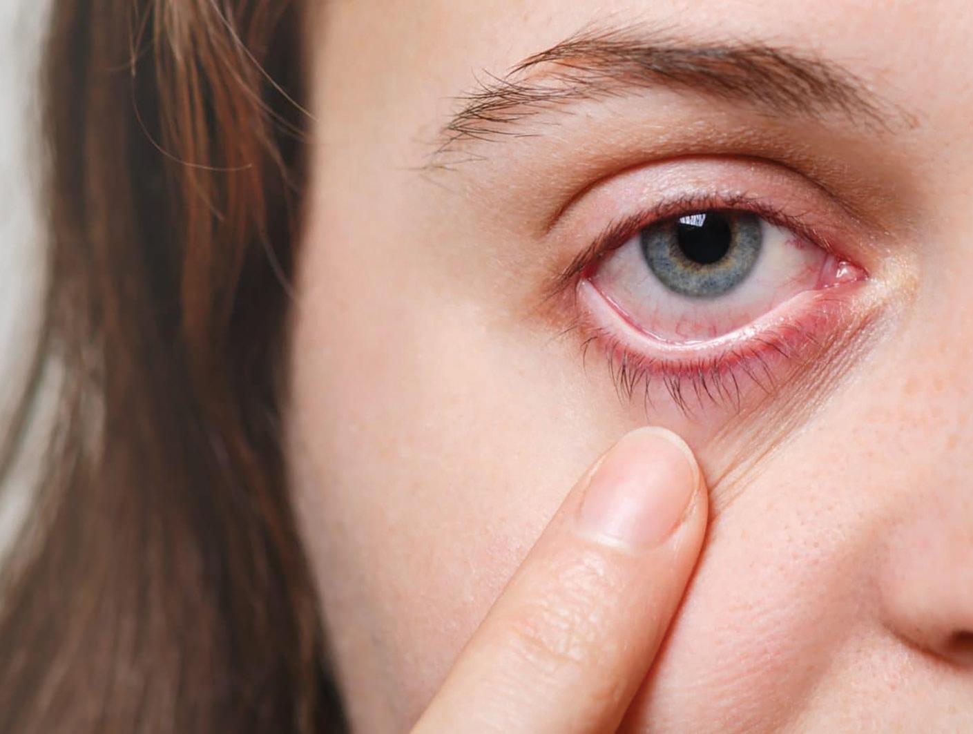 India eliminates Trachoma & makes big strides in Malaria fight ...